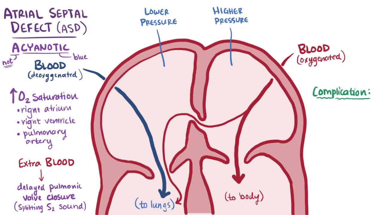 Atrial Septal Defect Asd Repair Causes Types Symptoms Pathology - wideo ...
